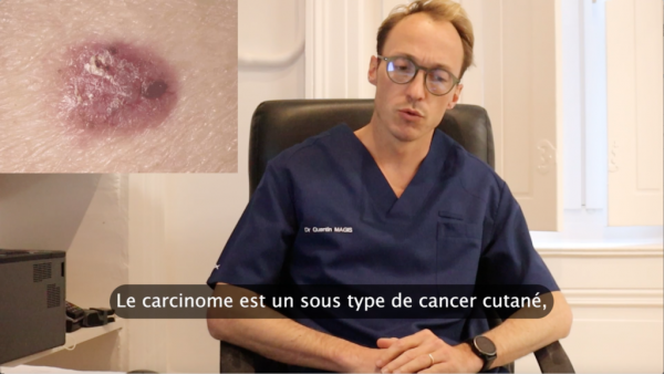 PRISE EN CHARGE DU CARCINOME BASOCELLULAIRE À LYON